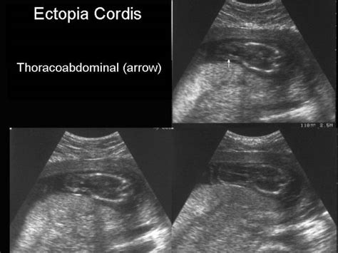 Ectopia Cordis In A Firsttrimester Sonographic Screening Program For Pdf Prenatal Diagnosis Of