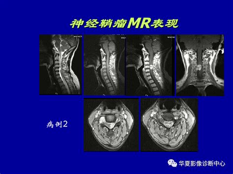 脊柱和脊髓常见病变的mri诊断脊柱脊髓影像骨科 健康界
