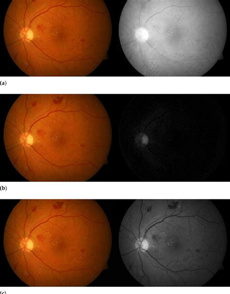 Figure 3 From Hemorrhage Detection Based On 3d Cnn Deep Learning