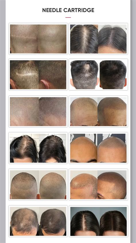 Factory Customise Logo Auto Scalp Micropigmentation Machine Pmu Smp