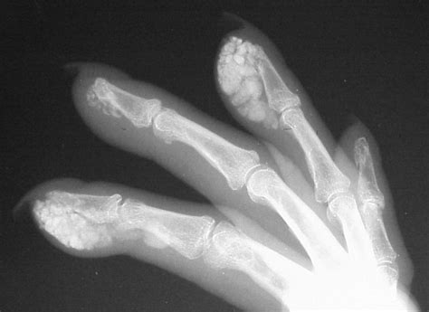 Transformation Crest Syndrome With Scleroderma Telangiectasias And