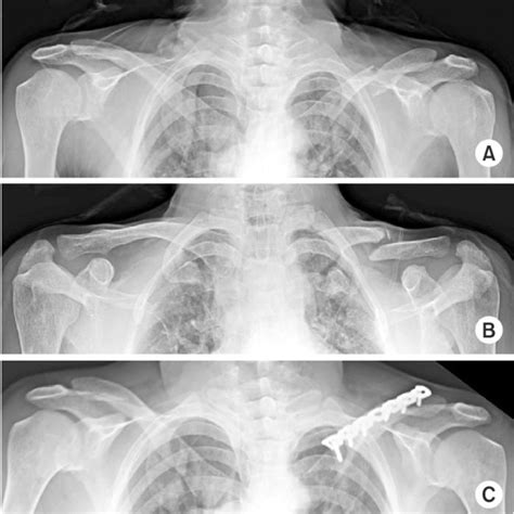 Mock Up In The Mouth Occlusal Interference Is Created That Acts As Download Scientific Diagram