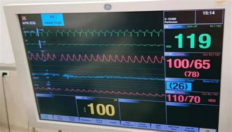 Не издржа срцето од свиња во човечко тело Ohridsky