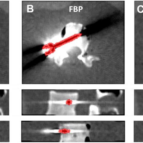 Reconstructions Of Digital Phantom Data That Includes One Pedicle Screw Download Scientific