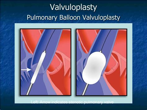 Ppt Adult Congenital Heart Disease Powerpoint Presentation Free