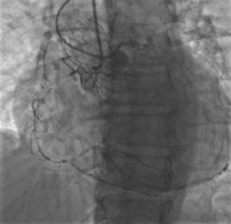 Bilateral Injection Demonstrating Long Rca Cto With Non Ambiguous Download Scientific Diagram