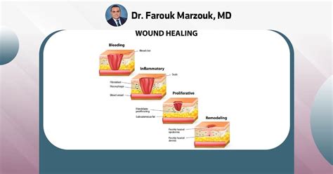 What Are The 4 Stages Of Wound Healing Frontier