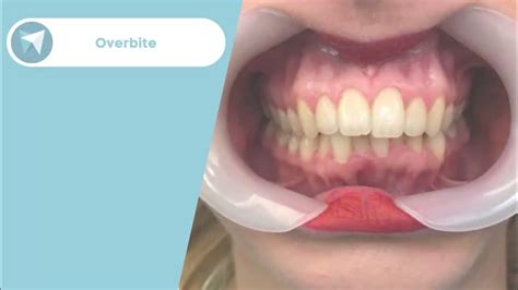 Overbite Treatment Before After Forest And Ray Dentists Orthodontists Implant Surgeons