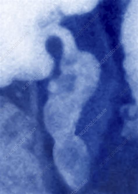 Appendicitis X Ray Stock Image C0020589 Science Photo Library