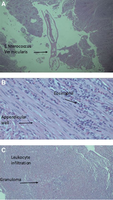 A Enterobius Vermicularis In The Lumen Of The Appendix B