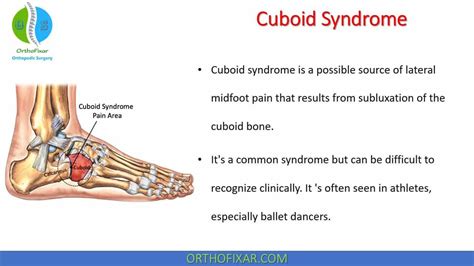 Cuboid Syndrome Easy Explained Artofit