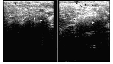 Figure 3 From Ultrasound Observation Of The Sciatic Nerve And Its Branches At The Popliteal