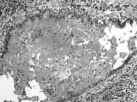 Figure 3 From Mucoid Impaction After Segmental Resection Of Lung