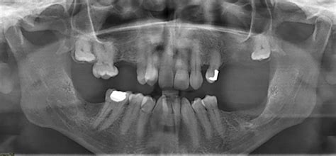 Dental Update Bilateral Dentigerous Cysts An Updated Literature Review And Report Of A Case
