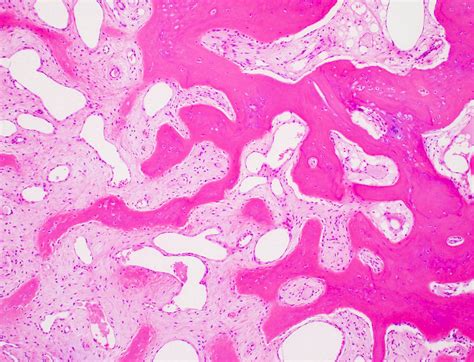 Pathological Fracture Osteoporosis