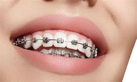 Cuenin Orthodontics Orthodontists Located In Danville Ca