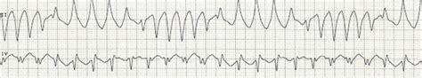 Шлуночкова тахікардія поліморфна на амбулаторному прийомі Чаcтина Ii