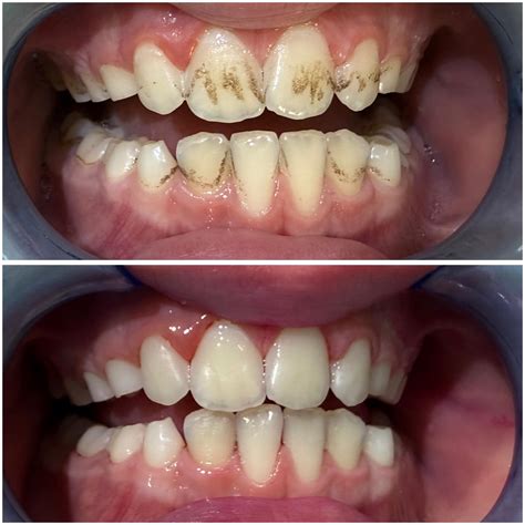 🔺შავი ნადები კბილებზე ე წ პრისლის ნადები შავი პიგმენტური ნადები ხშირად გვხვდება ბავშვთა