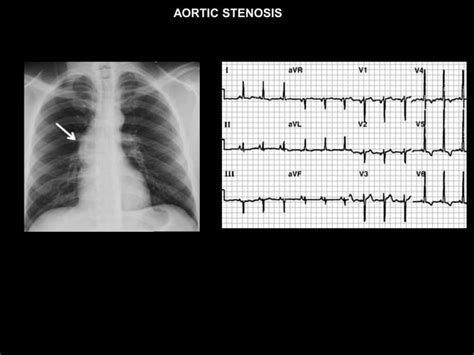 Aortic Stenosis Ppt