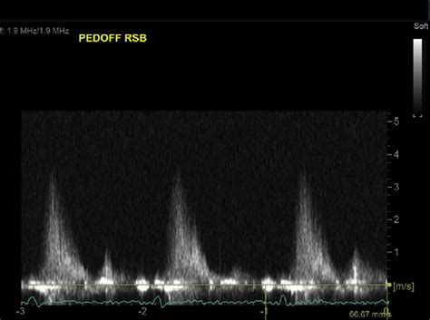 Continuous Wave Doppler Profile Obtained At The Right Sternal Border Download Scientific