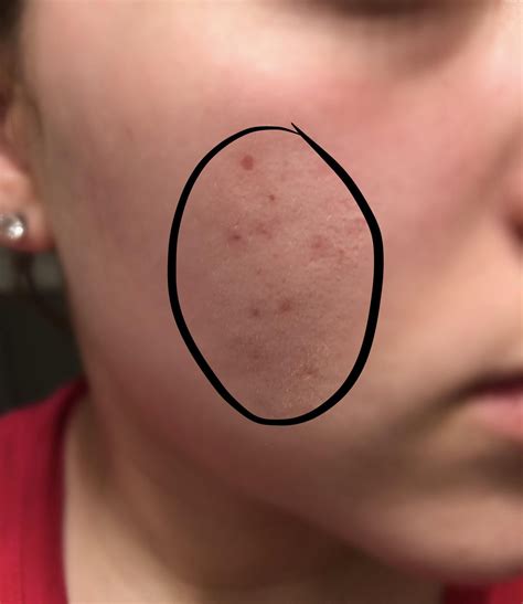 Skin Concerns Perioral Dermatitis Story In Comments Artofit