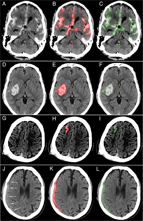 Intraparenchymal Hemorrhage Vs Subarachnoid Hemorrhage