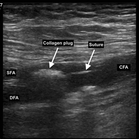 Ultrasound Image Of The Left Groin Demonstrating Echogenic Structure At