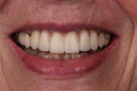 Implant Anterior Implant Bridge — Texas Dental Solutions