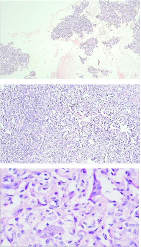 Tissue Biopsy From Left Tibia On Hande Staining On ×120 ×220 ×440