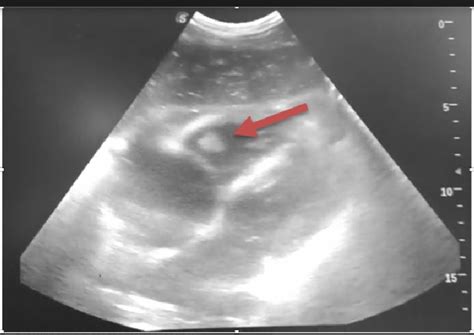 Subxiphoid View Showing A Clot In Transit In The Right Ventricle Arrow Download Scientific Subxiphoid View Showing A Clot In Transit In The Right Ventricle Arrow Download Scientific