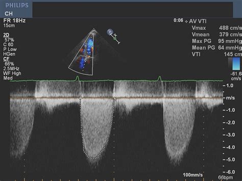 Continuous Wave Doppler Signal Revealing A Peak Velocity Of M Sec Download Scientific