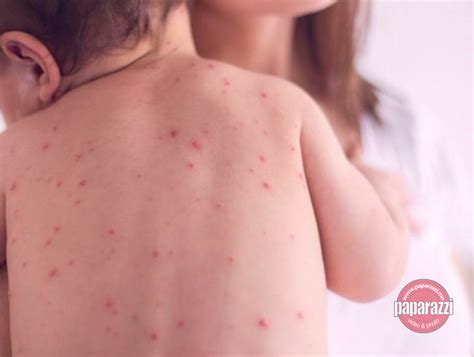 ХӨСҮТ Улаанбурхан өвчний лабораториор батлагдсан тохиолдол 11016 болжээ