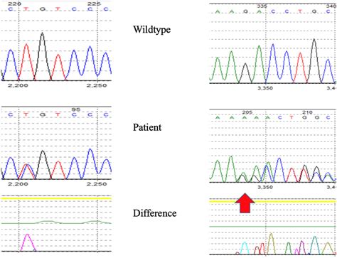 Sanger Sequencing C707tc Variant With Amino Acid Substitution And