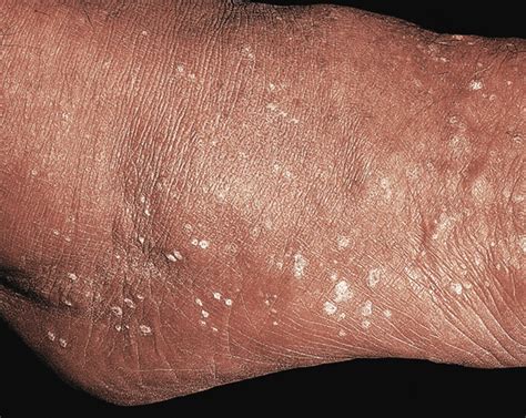 Flat Warts On Legs