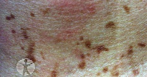 Persistent Pigmented Macules Image