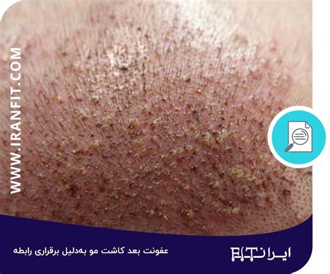 چند روز بعد از کاشت مو می‌توان رابطه داشت؟ عوارض رابطه جنسی بعد از کاشت
