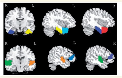 Figure 1 From What The Left And Right Anterior Fusiform Gyri Tell Us