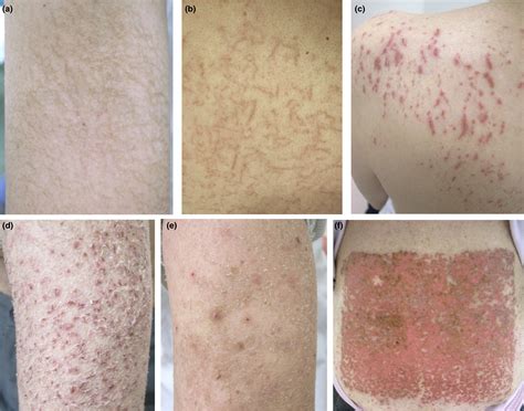 Flaky Skin Zinc At Marsha Shain Blog
