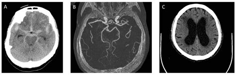 Subarachnoid Hemorrhage