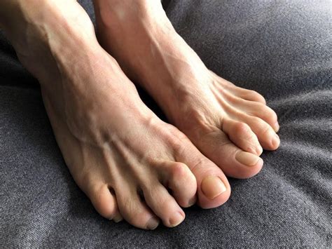 Hammertoe Surgery What To Expect With The Procedure