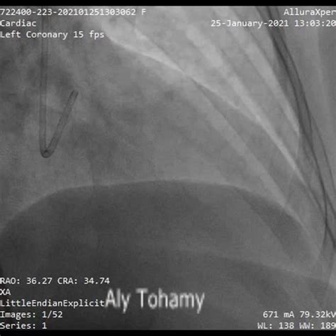 Aly Tohamy On Linkedin Lad D Bifurcation Using Minicrush Technique