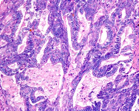 Example Of Epithelial Ovarian Cancer At Isabelle Odonovan Blog