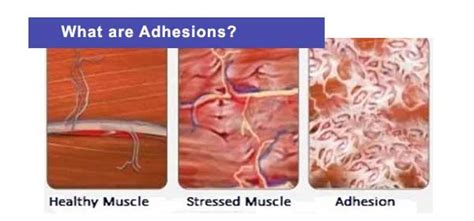 What Are Adhesions Medical Massage Therapy