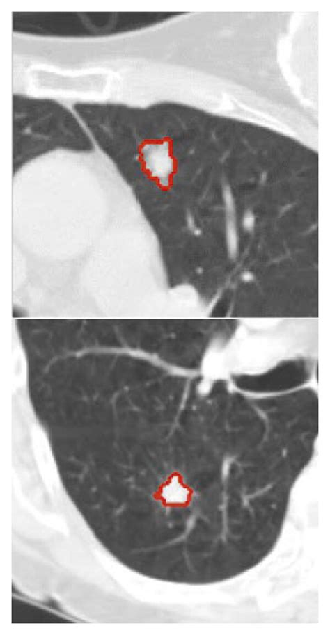 Comparison Of Segmentation Between Conventional Random Walker And Download Scientific Diagram