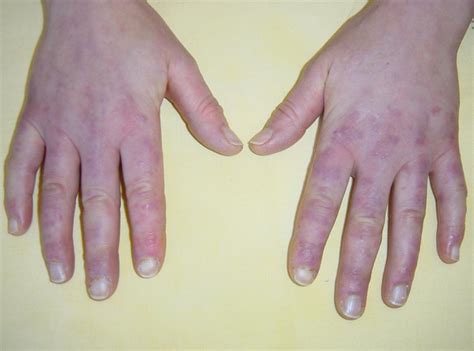 Chilblains Vasa