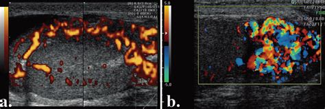 Epididymitis Without Orchitis Complete Epididymitis Depicted By Power Download Scientific