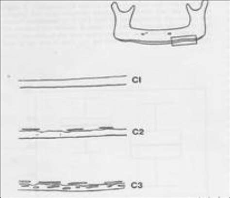 Mandibular Cortical Index Download Scientific Diagram