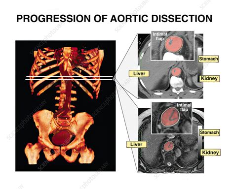 Progression Of Aortic Dissection Illustration Stock Image C0593558 Science Photo Library