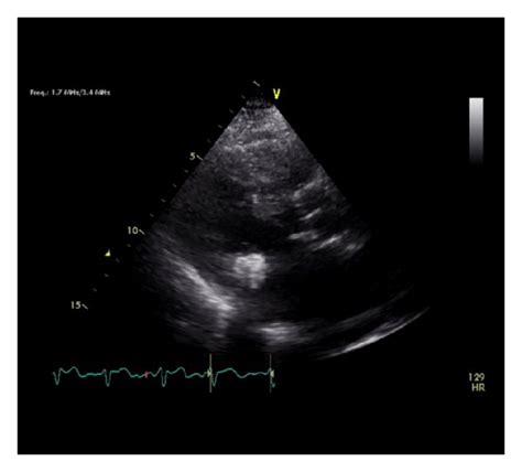 Transthoracic Echocardiogram Views Four Standard Views That Show A Download Scientific Diagram