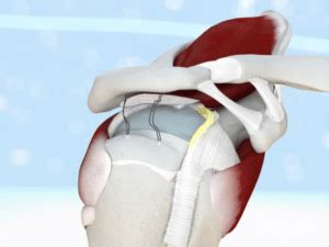How A Torn Rotator Cuff Is Repaired High Mountain Orthopedics